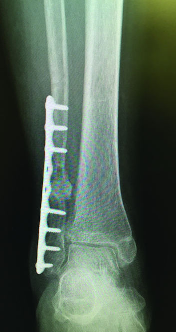Assessing The Potential Of Realignment Fibula Osteotomy For Distal ...