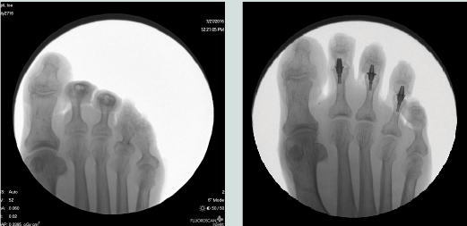 Two-Piece Hammertoe Implant Offers Easier Insertion