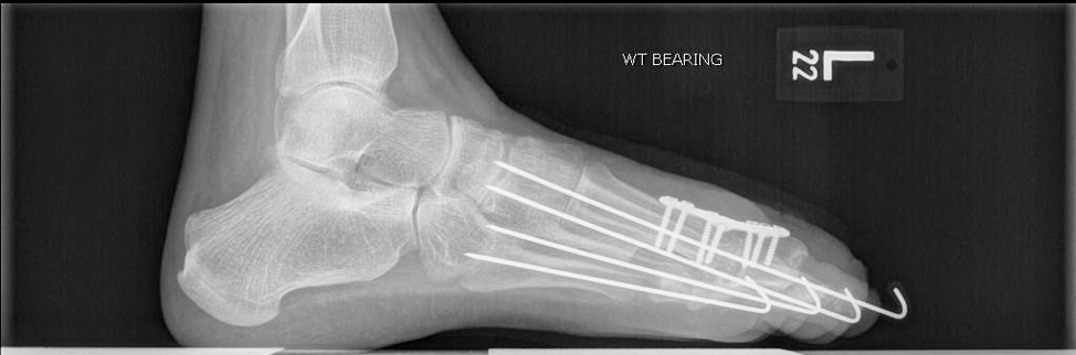 Plantarflexion Contracture Walkwellstaywell