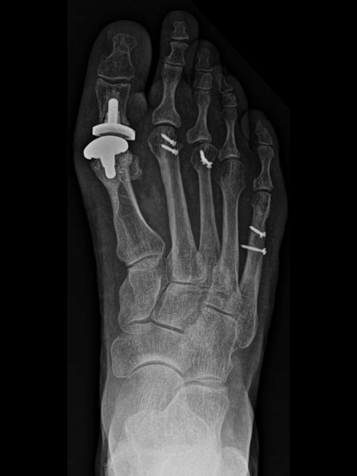 Of Large Toe Joint Replacement