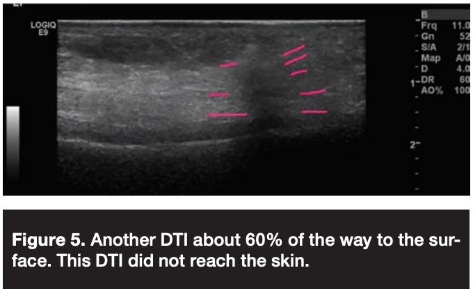 Special to OWM: Highlights from the International Forum on Deep Tissue ...