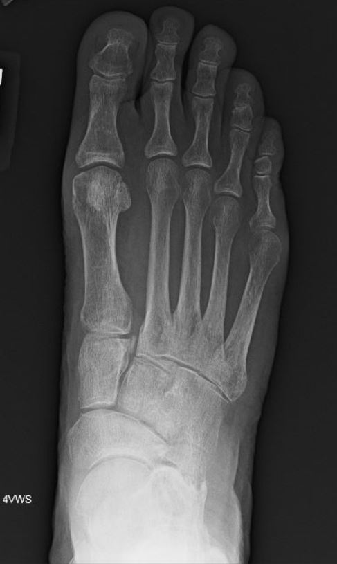 A Closer Look At An Isolated Foot Delta Frame Construct For Fracture ...