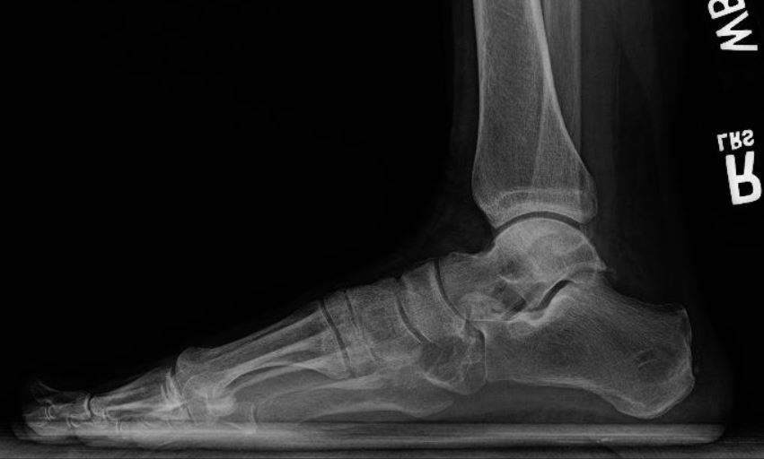A Closer Look At An Isolated Foot Delta Frame Construct For Fracture ...