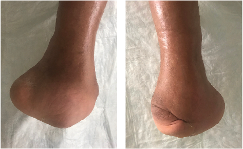 Achieving Optimal Offloading After A Chopart Amputation