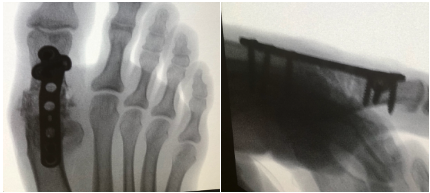 A Guide To Revising First MPJ Arthrodesis With Combined Allograft And ...