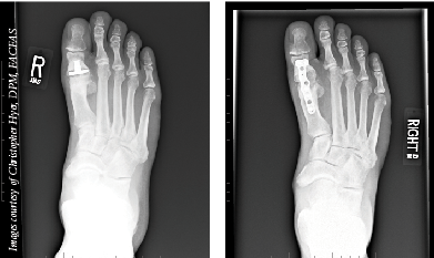 Addressing First MPJ Arthritis: A Roundtable Discussion
