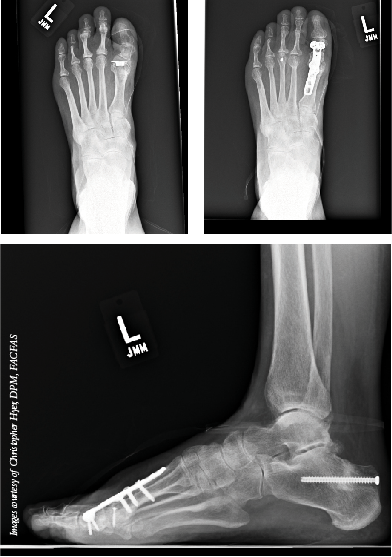 Addressing First MPJ Arthritis: A Roundtable Discussion