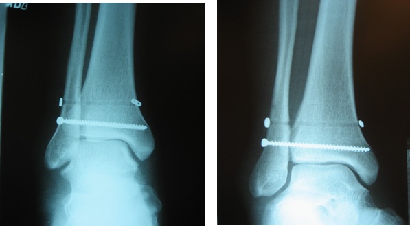 Treating High Ankle Sprains In Football Players