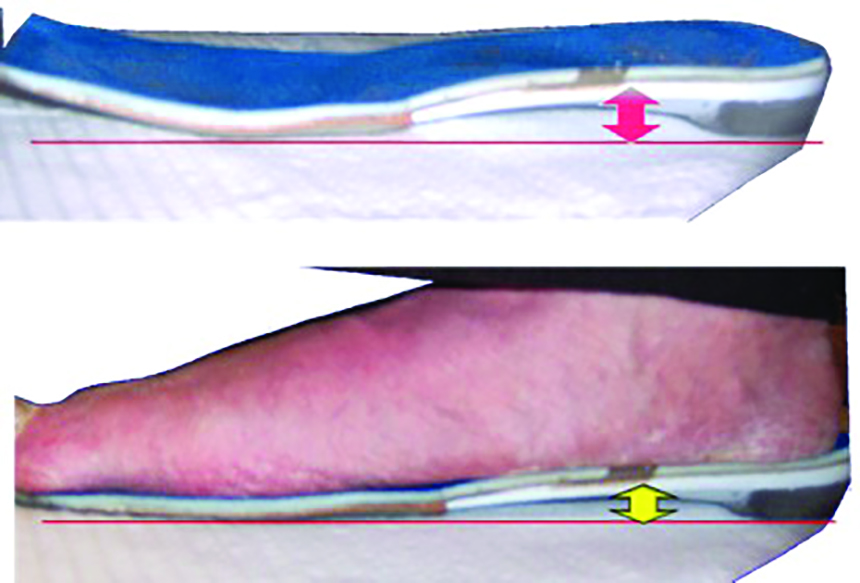 What You Should Know About Orthotic Materials And Torsional Stiffness