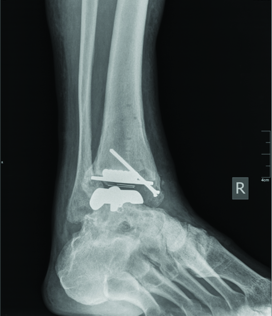 Biomechanical Considerations With Total Ankle Arthroplasty