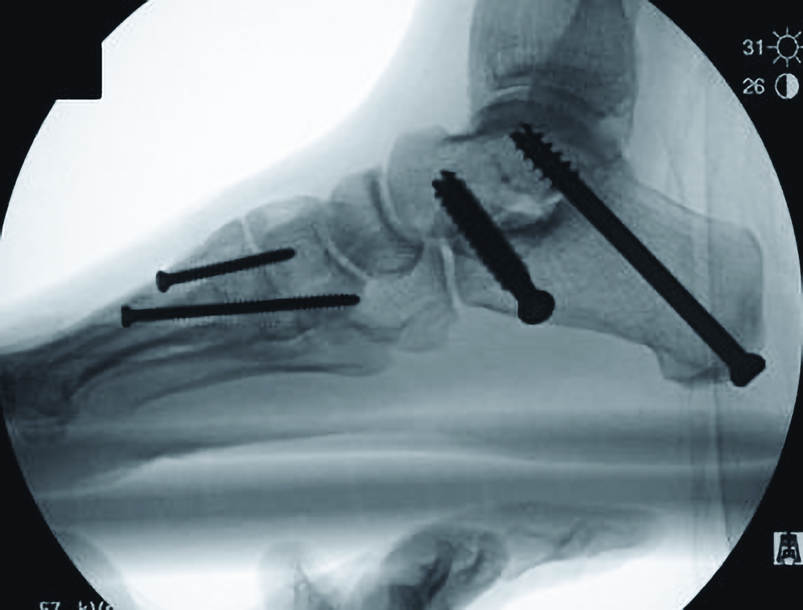 Essential Insights On Imaging For Reconstructive Flatfoot Surgery