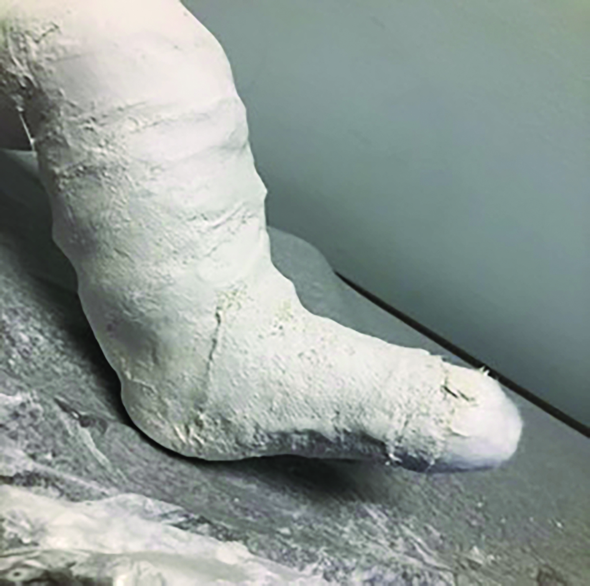 Addressing Equinus In The Pediatric Patient