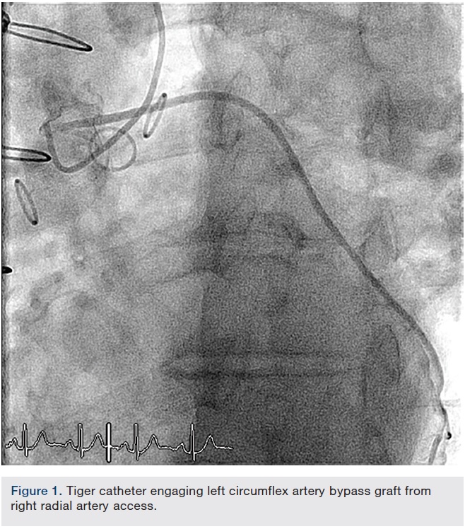 Bypass Graft Angiography From a Transradial Approach