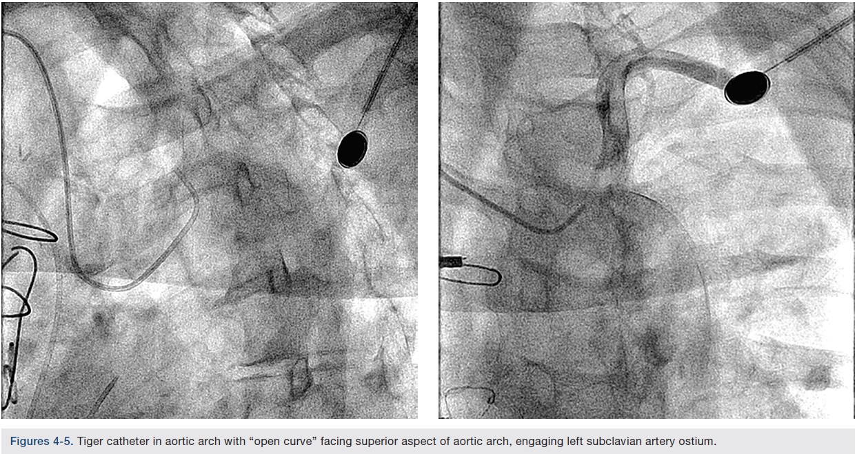 Bypass Graft Angiography From a Transradial Approach