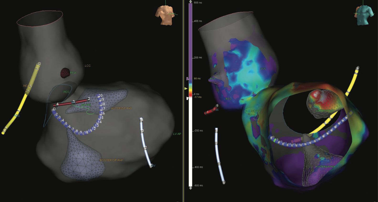 Effectively Treating Complex Cases with the EnSite Precision Cardiac ...