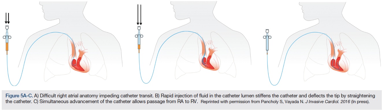 Right Heart Catheterization From an Upper Extremity