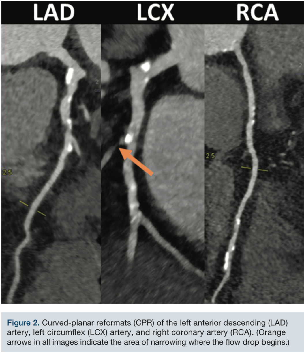 High-Quality cCTA Imaging Enables FFRct Analysis