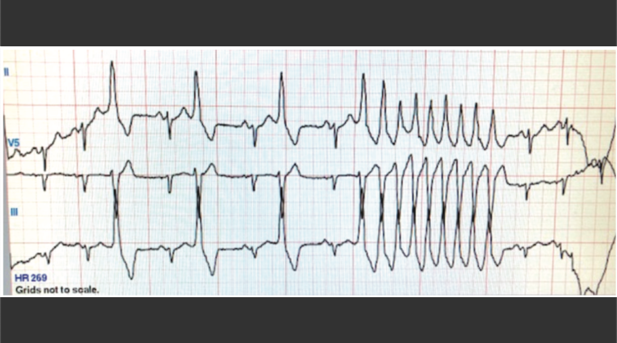 Wolff Parkinson White Syndrome