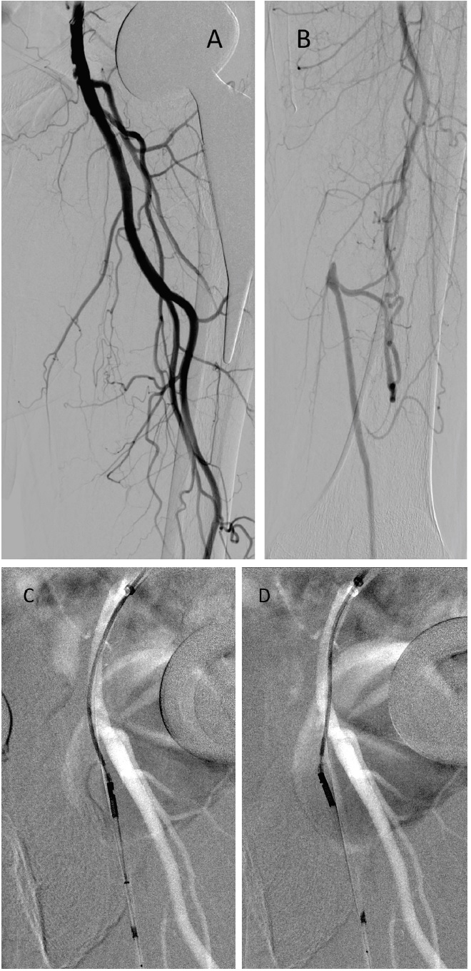 A Real-World Comparison of IN.PACT vs Lutonix Drug-Coated Balloons in ...