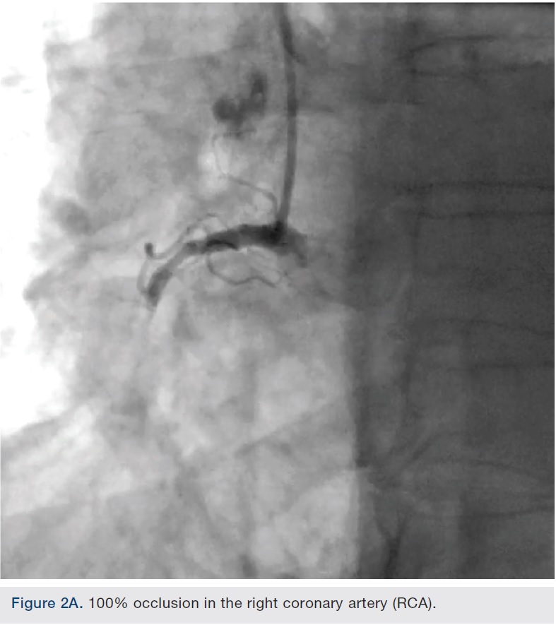 Coronary Atherectomy and Transradial Access Part I of III: Laser ...