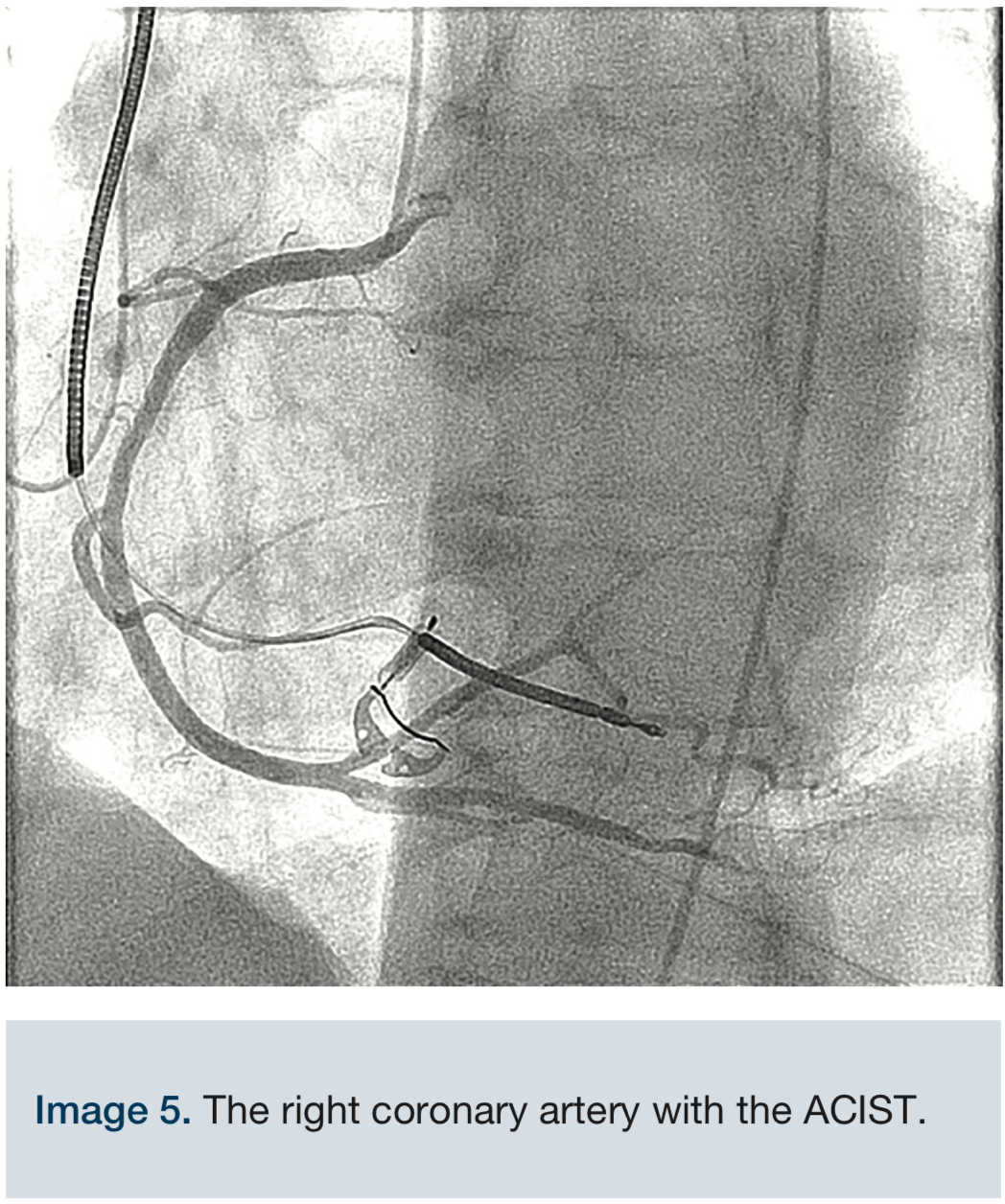 Use of the ACIST CVi System in Structural Heart Interventions ...