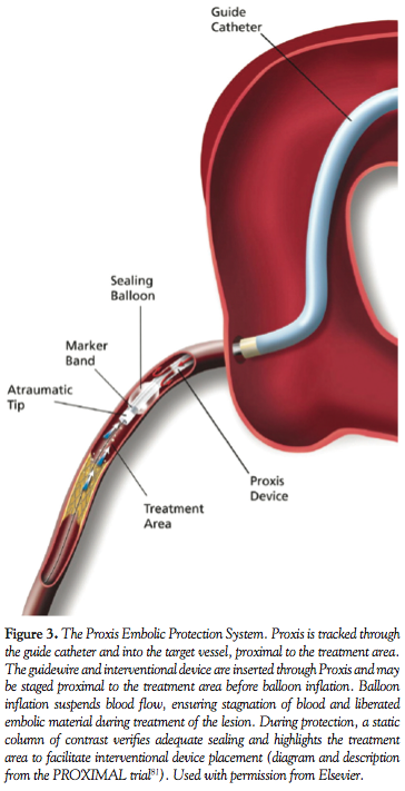 Saphenous Vein Graft Intervention: A Review | Journal of Invasive ...