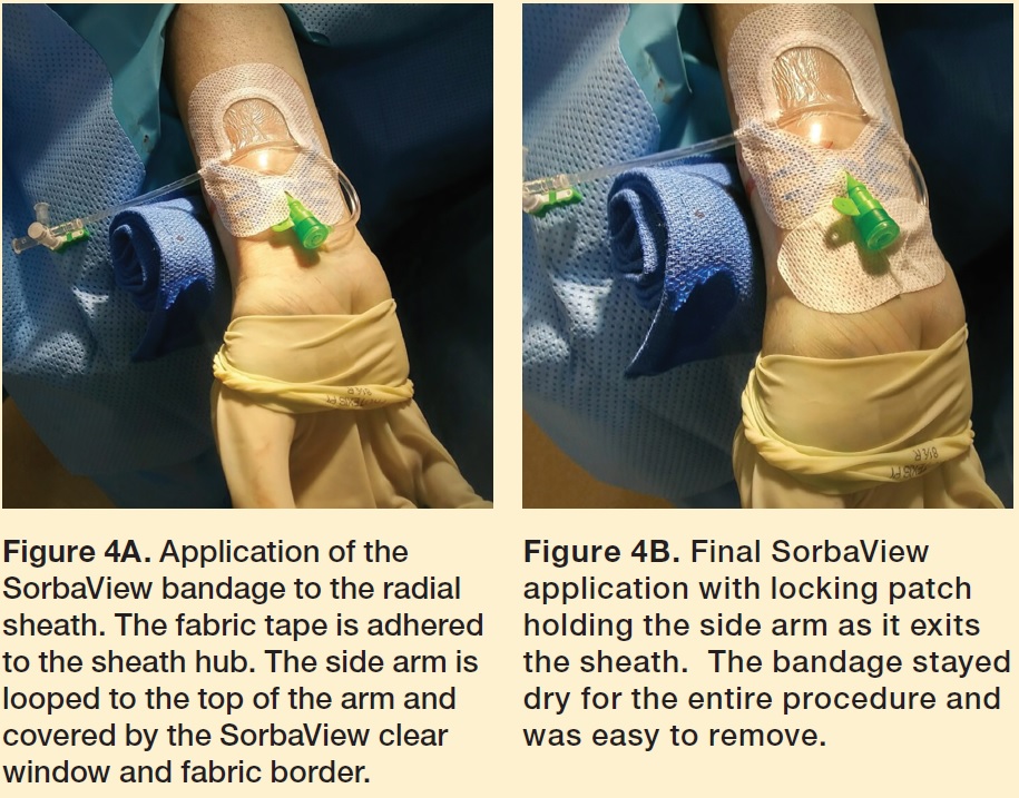 How Do You Secure Your Radial Sheath?
