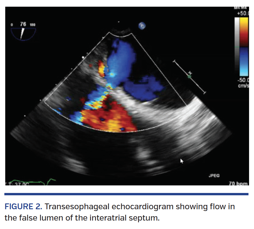 Interatrial Septal Dissection Complicating a MitraClip Procedure