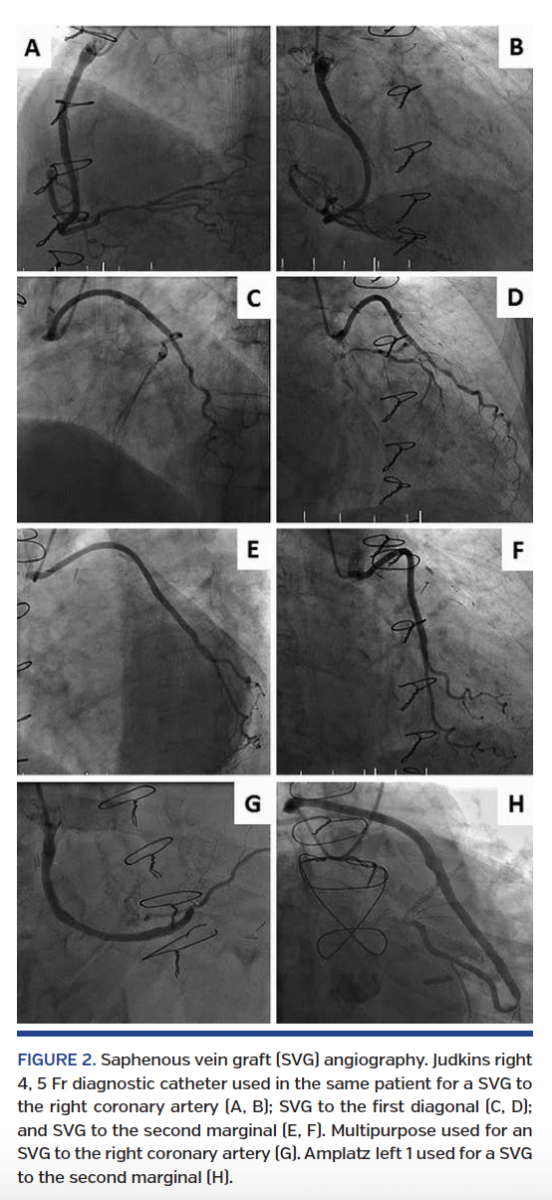 Transradial Approach for Post-Coronary Artery Bypass Graft Angiography ...