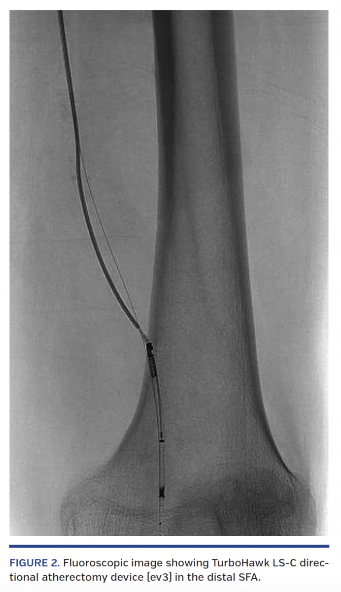 Atherectomy in Peripheral Artery Disease: A Review