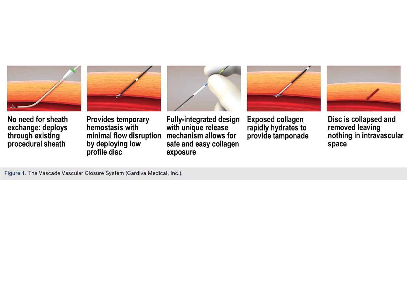 A Novel Vascular Closure Device for Heart Transplant Patients