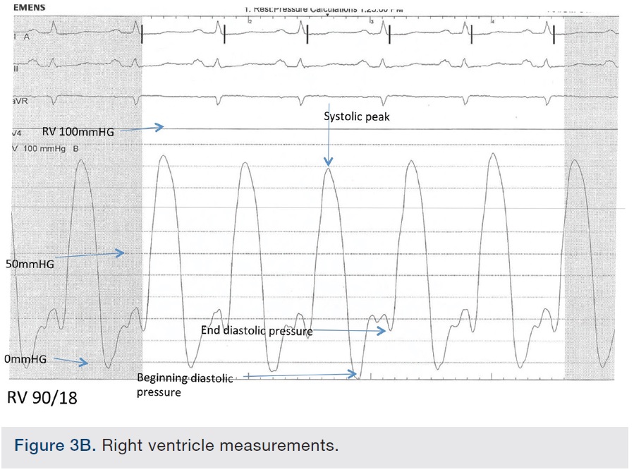 Test Your Knowledge: An Overview of Pulmonary Hypertension and an ...