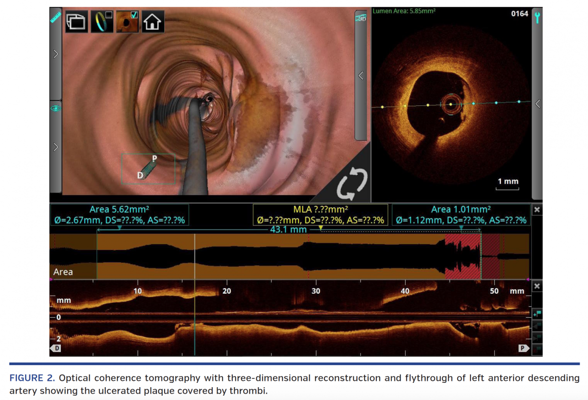 Utility of 3D-OCT Imaging With Angiographic Co-Registration in Acute ...