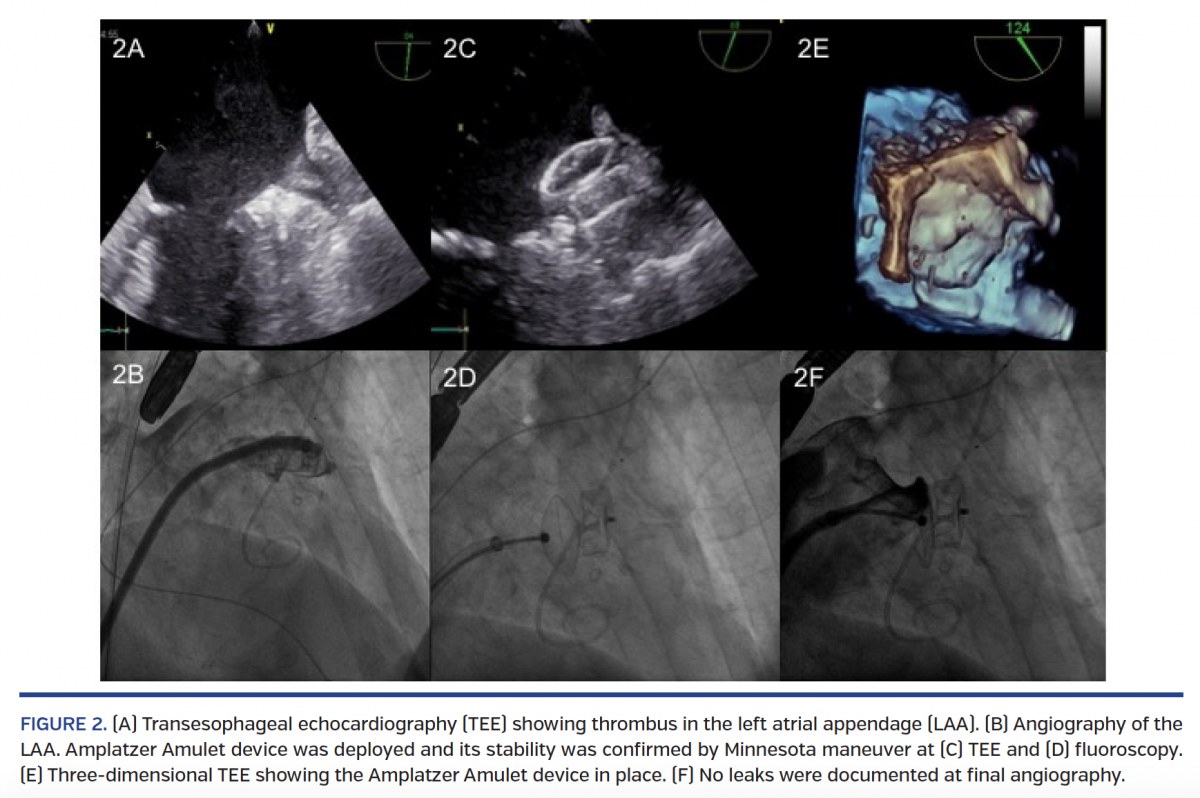 First-in-man Percutaneous LAA Closure With an Amplatzer Amulet and ...