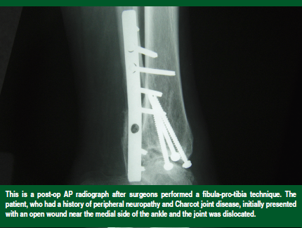 Can The Fibula-Pro-Tibia Technique Have An Impact For Diabetic Ankle ...