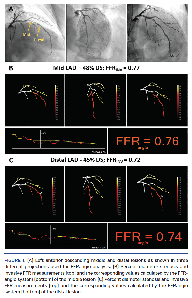 Online Angiography Image-Based FFR Assessment During Coronary ...