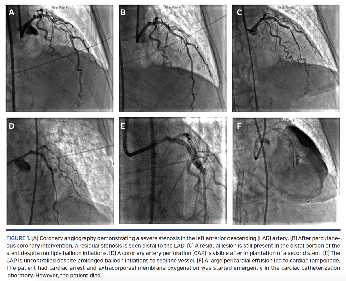 Coronary Artery Perforation Following Percutaneous Coronary Intervention