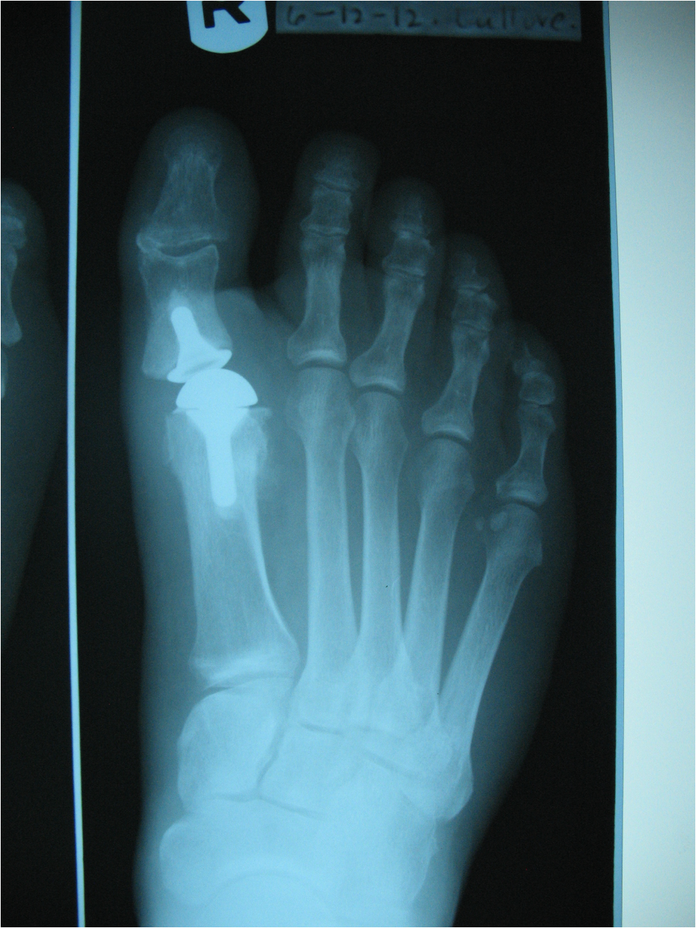 Pertinent Insights On Total Joint Replacement Of The First MPJ