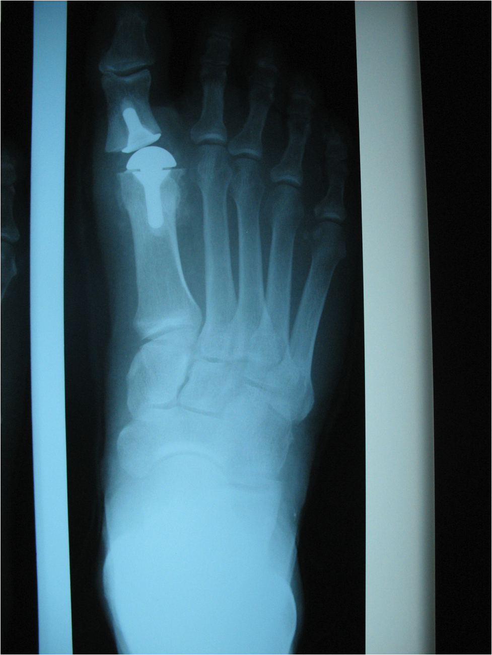 Pertinent Insights On Total Joint Replacement Of The First MPJ