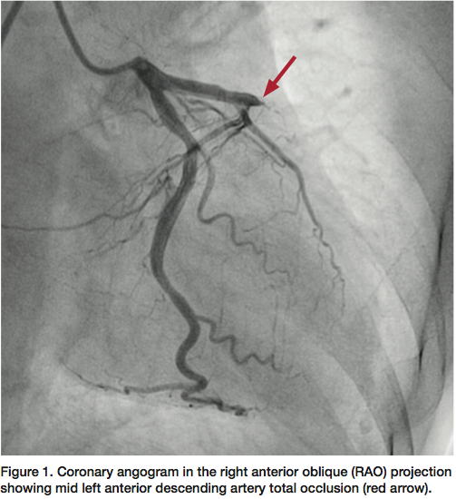 Hyperdominant Left Anterior Descending Artery Continuing as Posterior ...