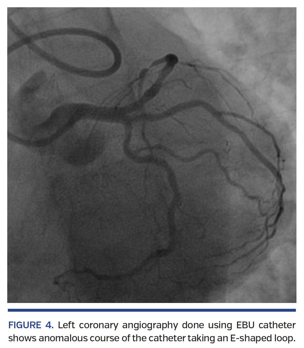 Incidental Detection of Arteria Lusoria During Transradial Coronary ...