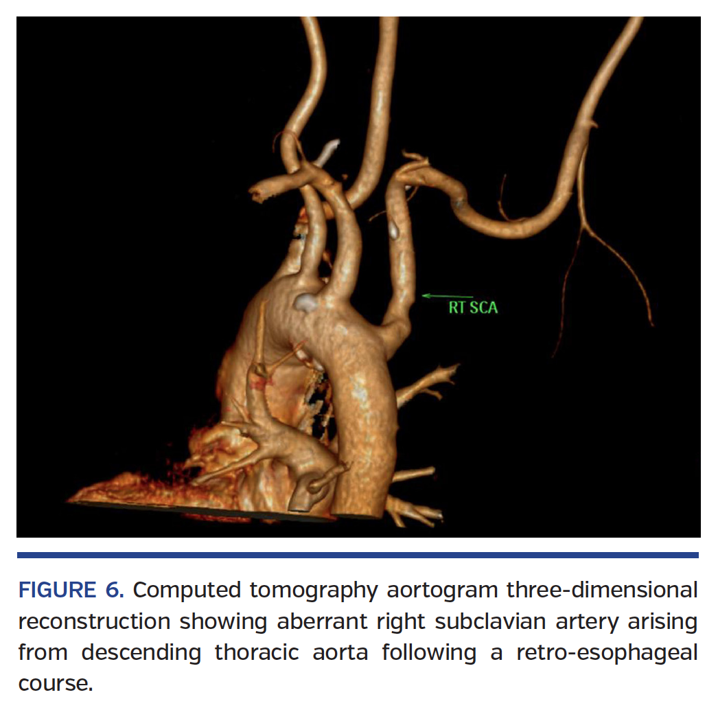 Incidental Detection of Arteria Lusoria During Transradial Coronary ...