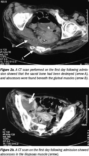 Iliopsoas Muscle Abscess Secondary to Sacral Pressure Ulcer Treated ...