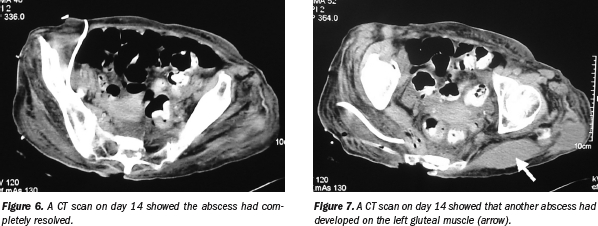 Iliopsoas Muscle Abscess Secondary to Sacral Pressure Ulcer Treated ...