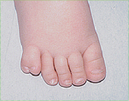 How To Treat Polysyndactyly And Syndactyly Of The Foot