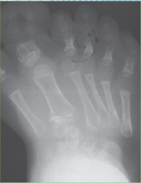How To Treat Polysyndactyly And Syndactyly Of The Foot