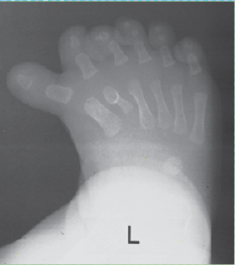 How To Treat Polysyndactyly And Syndactyly Of The Foot