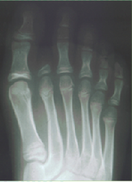 How To Treat Polysyndactyly And Syndactyly Of The Foot