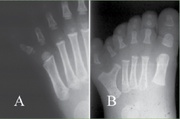 How To Treat Polysyndactyly And Syndactyly Of The Foot