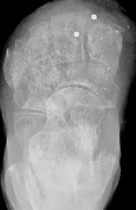 Treating Gunshot Wounds In The Lower Extremity